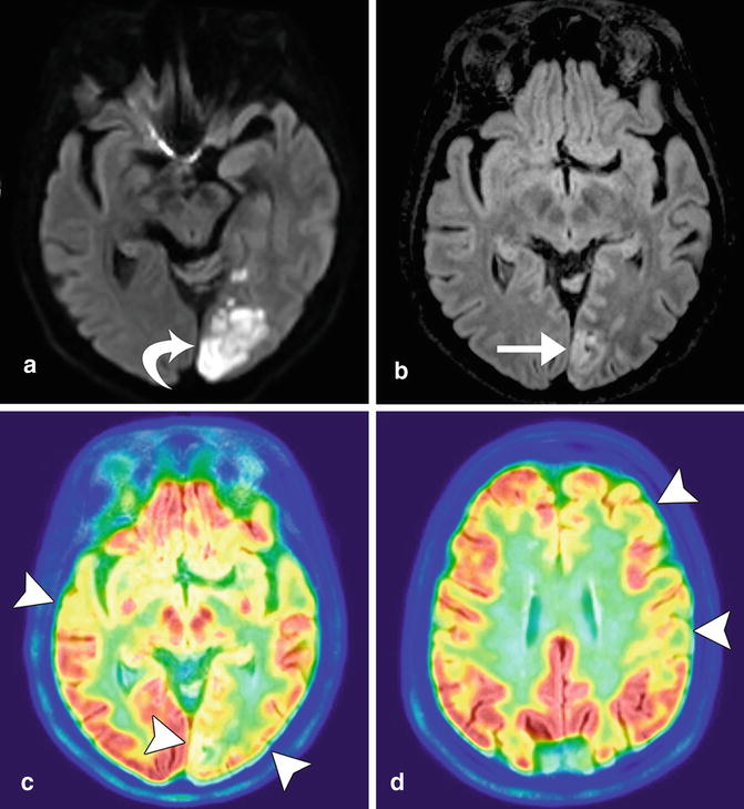 Vascular Dementia | SpringerLink