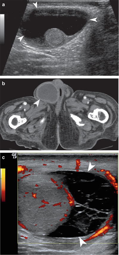 Imaging of Acute Conditions of Male Reproductive Organs | SpringerLink