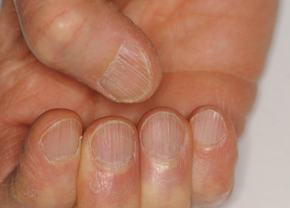 Trachyonychia | SpringerLink