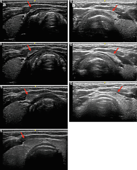 Normal Neck Anatomy and Method of Performing Ultrasound Examination ...