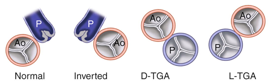 Terminology: Defining Cardiac Position, Chamber Morphology and Van ...