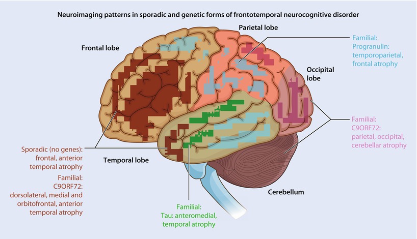 Major or Mild Frontotemporal Neurocognitive Disorder | SpringerLink