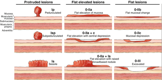 Beyond Piecemeal Polypectomy: EMR and ESD | SpringerLink