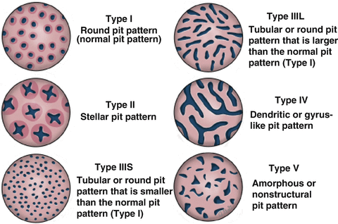 Beyond Piecemeal Polypectomy: EMR and ESD | SpringerLink