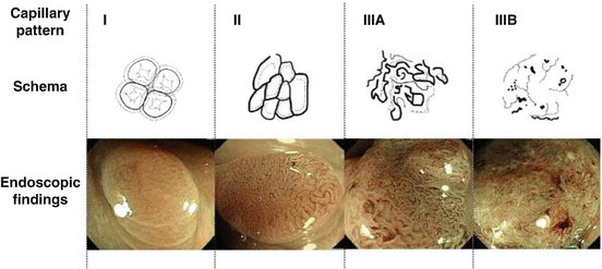 Beyond Piecemeal Polypectomy: EMR and ESD | SpringerLink