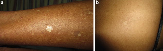 Guttate Leukoderma | SpringerLink