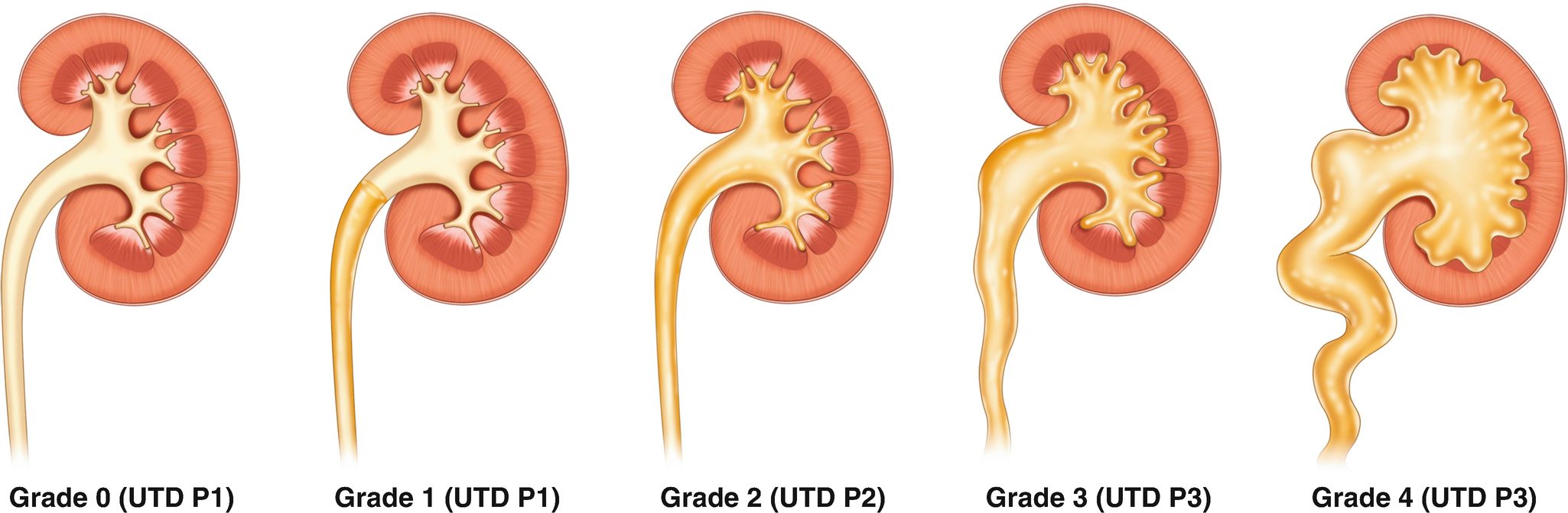 Obstructive Uropathy | SpringerLink