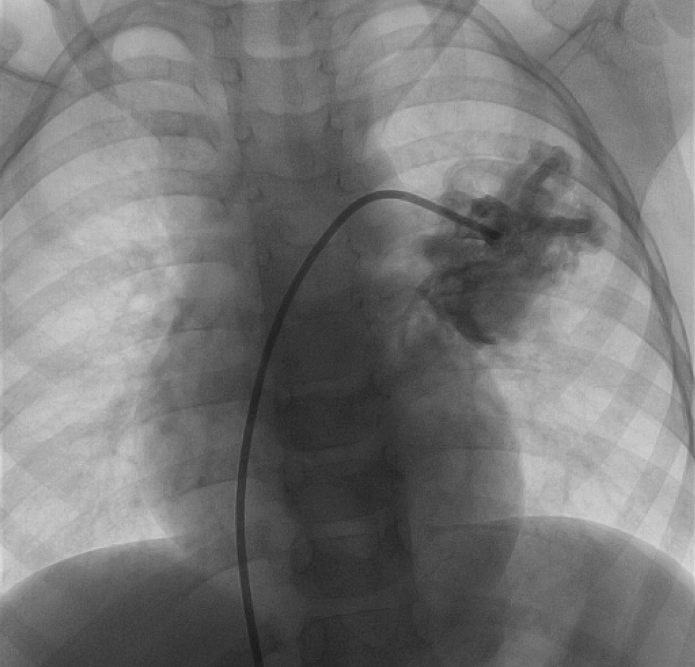 Vessel Embolization: Transcatheter Embolization of Pulmonary ...