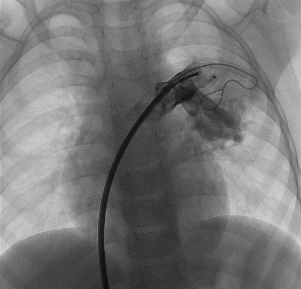 Vessel Embolization: Transcatheter Embolization of Pulmonary ...