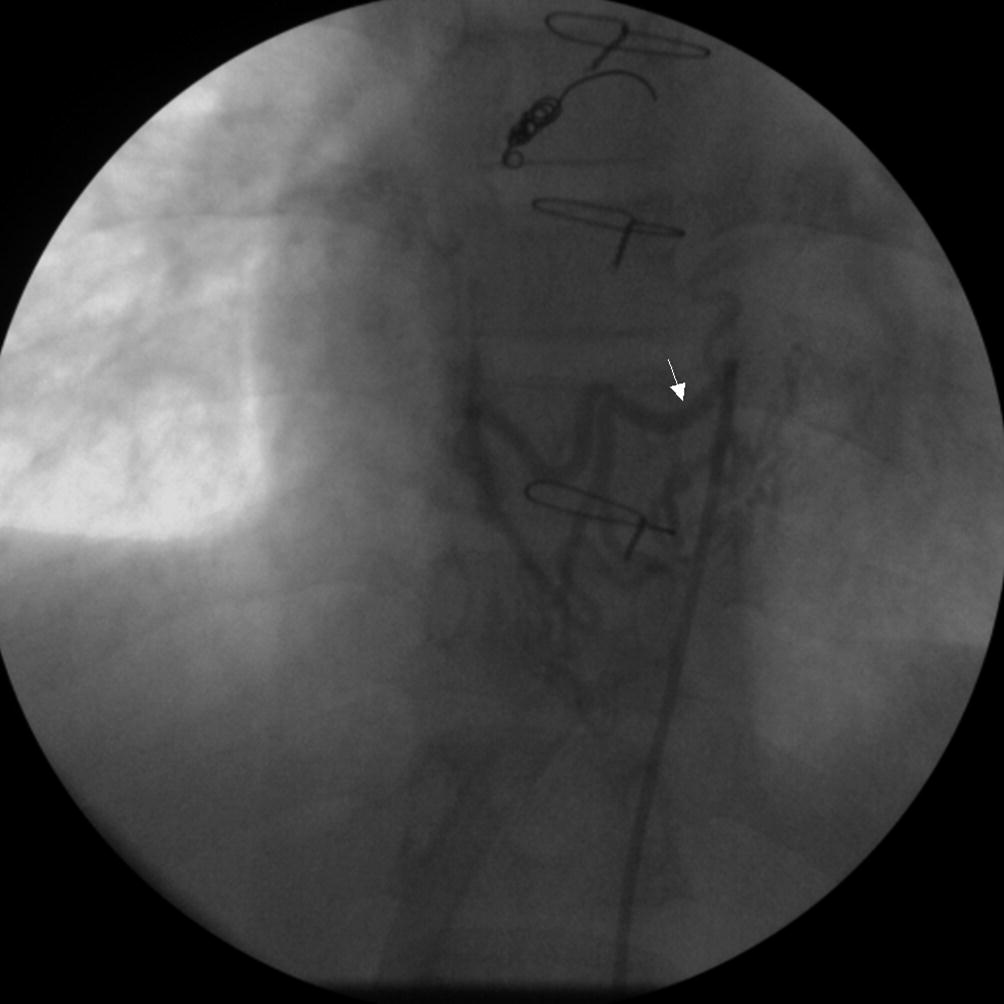 Vessel Embolization: Transcatheter Embolization of Pulmonary ...