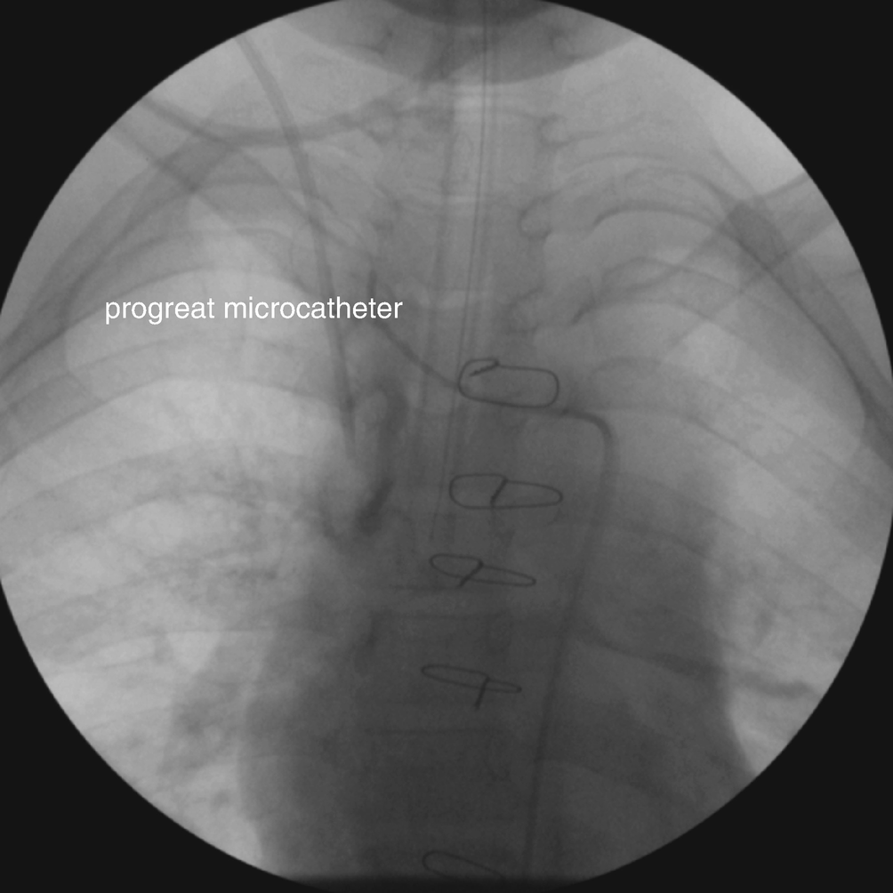 Vessel Embolization: Transcatheter Embolization of Pulmonary ...