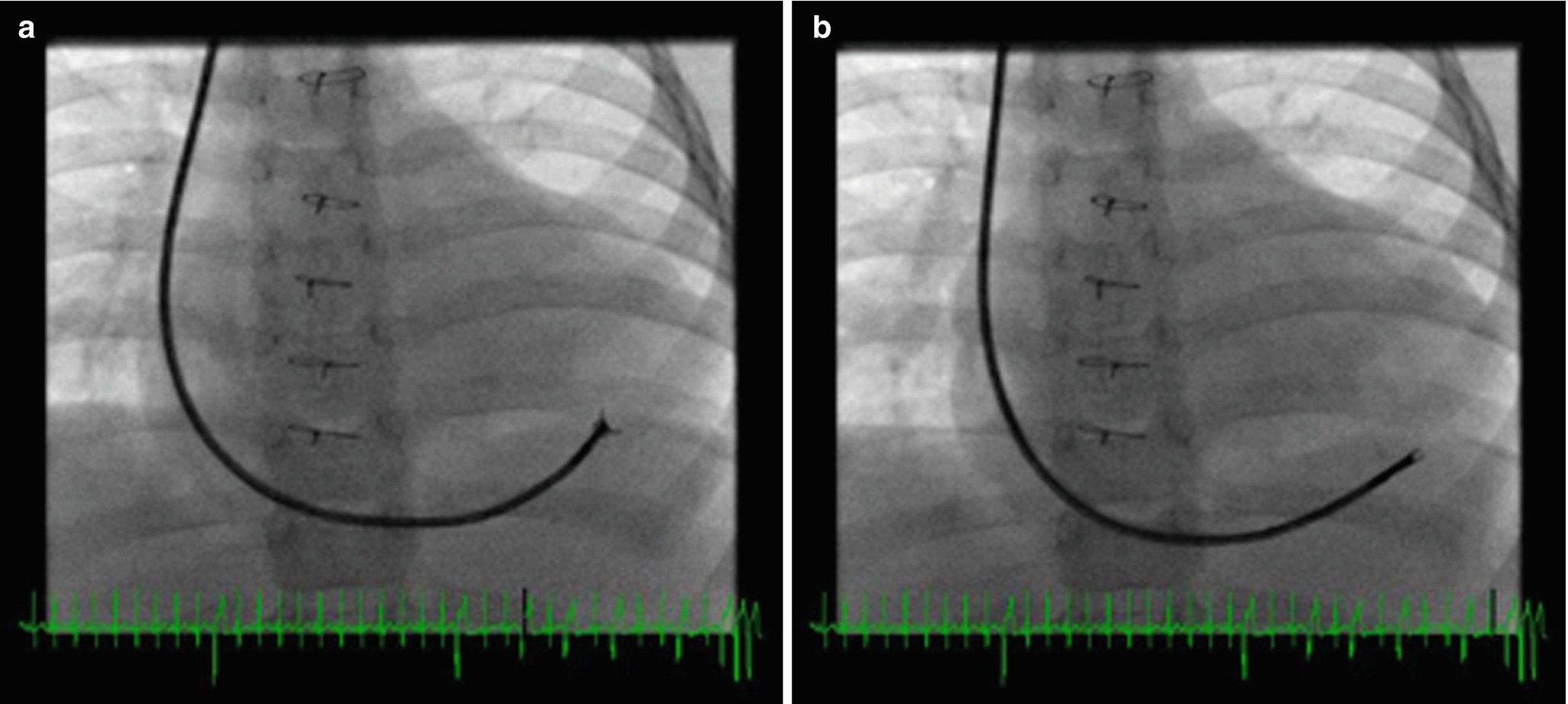 Endomyocardial Biopsies | SpringerLink