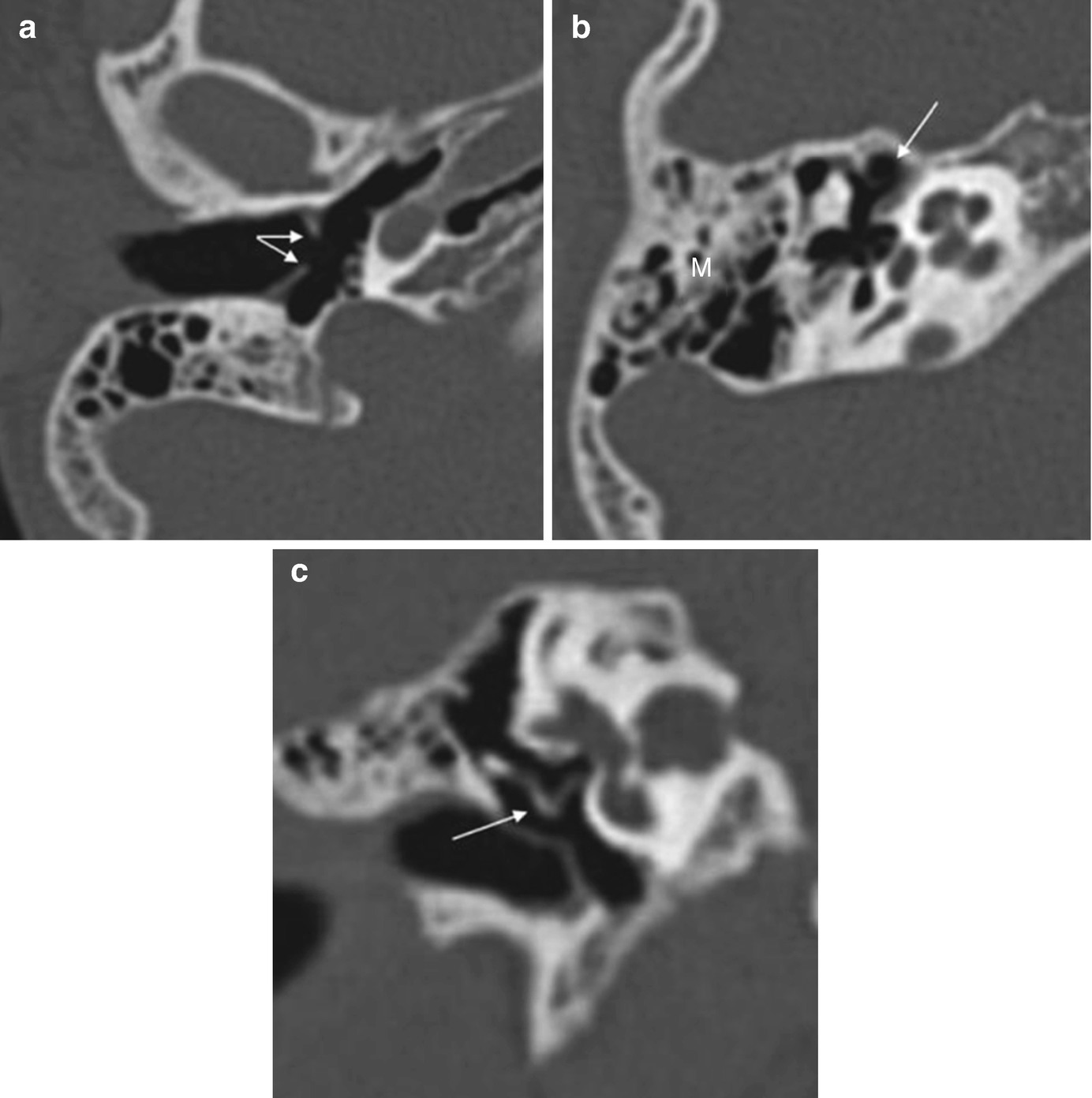 Chronic Suppurative Otitis Media (CSOM): A Middle Ear Mucosal Disease ...