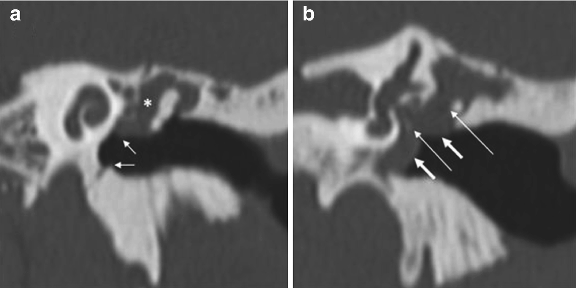 Chronic Suppurative Otitis Media (CSOM): A Middle Ear Mucosal Disease | SpringerLink