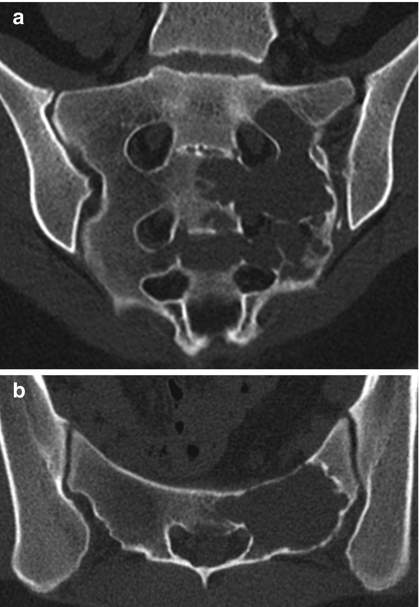 Sacral Aneurysmal Bone Cyst | SpringerLink