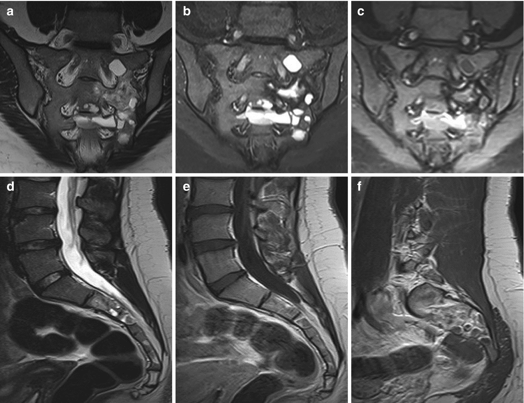 Sacral Aneurysmal Bone Cyst | SpringerLink