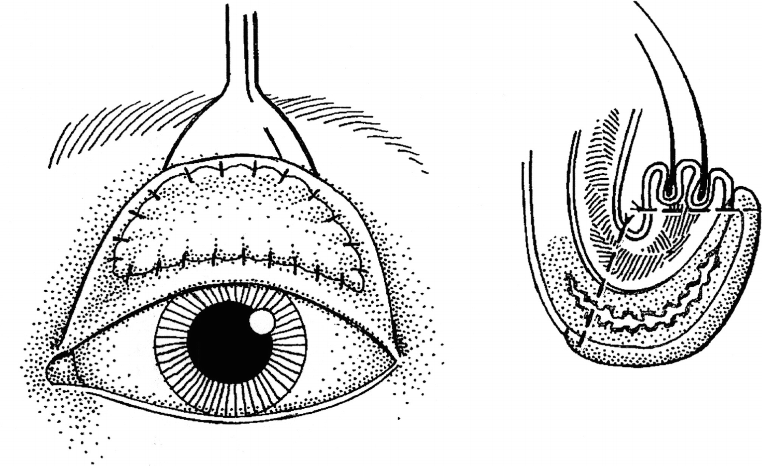 Trichiasis and Distichiasis | SpringerLink