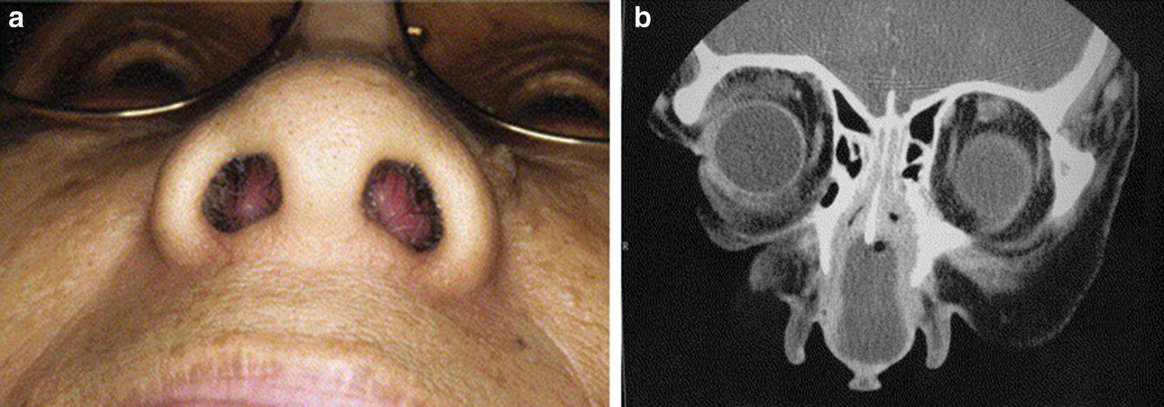 Nasal Infections | SpringerLink
