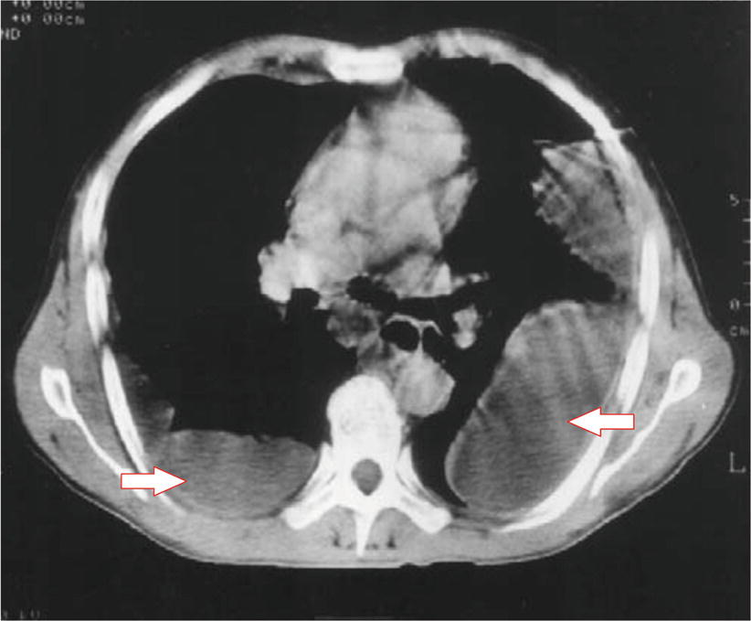 Lemierre’s Syndrome | SpringerLink
