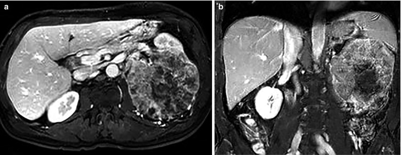 Renal Tumors | SpringerLink