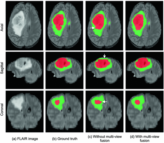 Automatic Brain Tumor Segmentation Using Cascaded Anisotropic