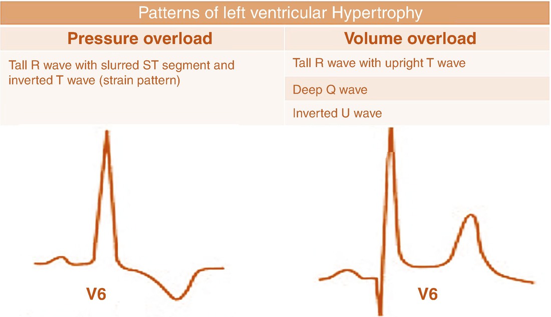 ECG in Cardiac Chamber Enlargement | SpringerLink