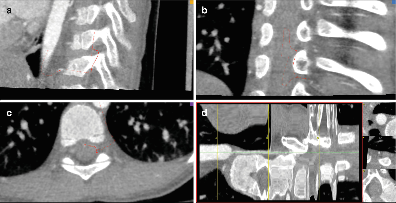 Preoperative Assessment of the Spinal Cord Vasculature | SpringerLink