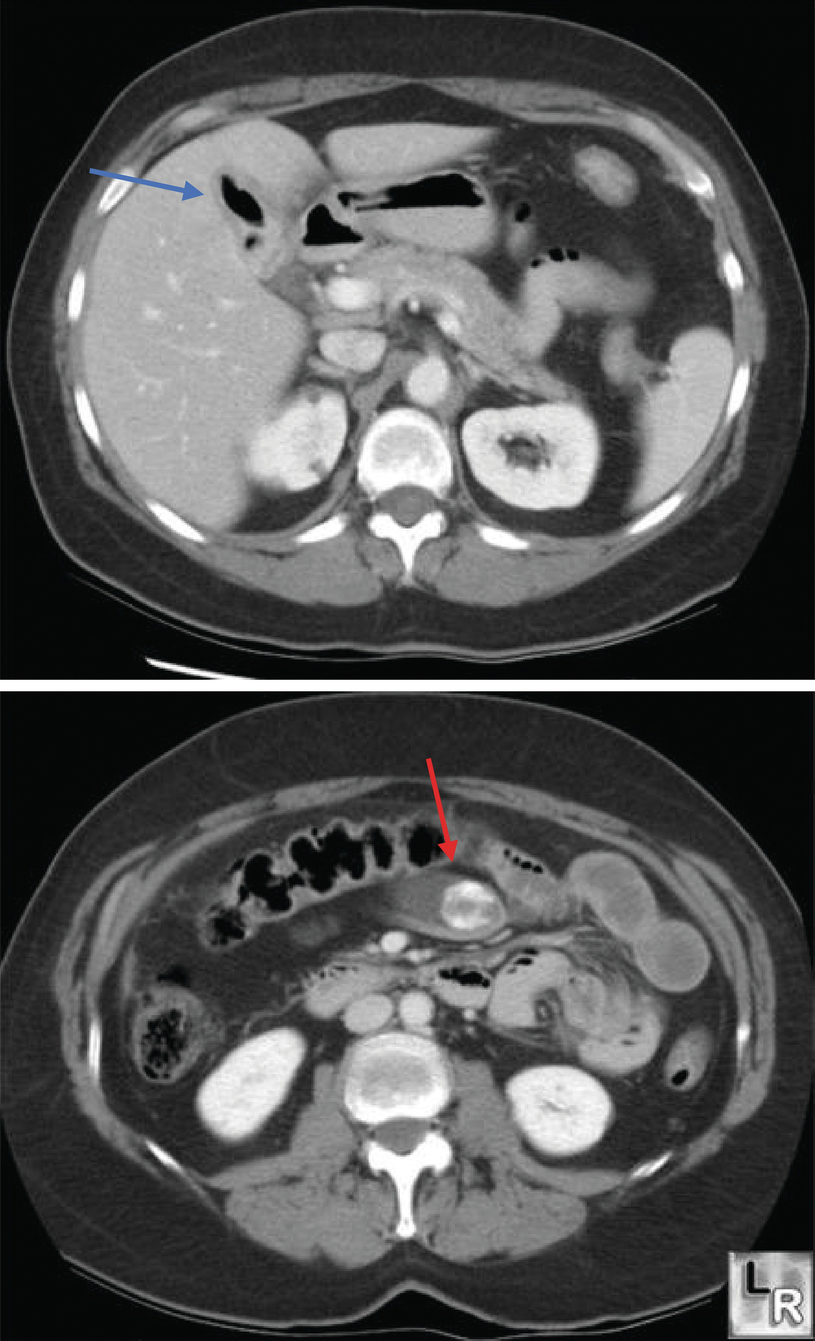 Gallstone Ileus | SpringerLink