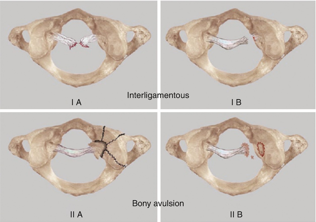 Upper Cervical Spine Trauma | SpringerLink