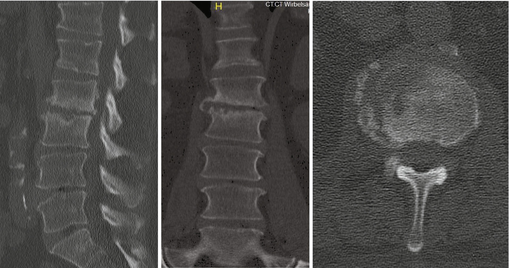 Vertebral Osteomyelitis: Etiology, Pathogenesis, Routes of Spread ...