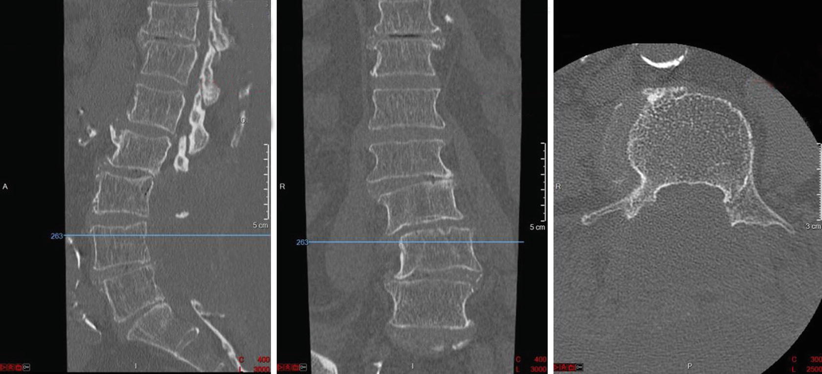 Management of CSF Fistula | SpringerLink