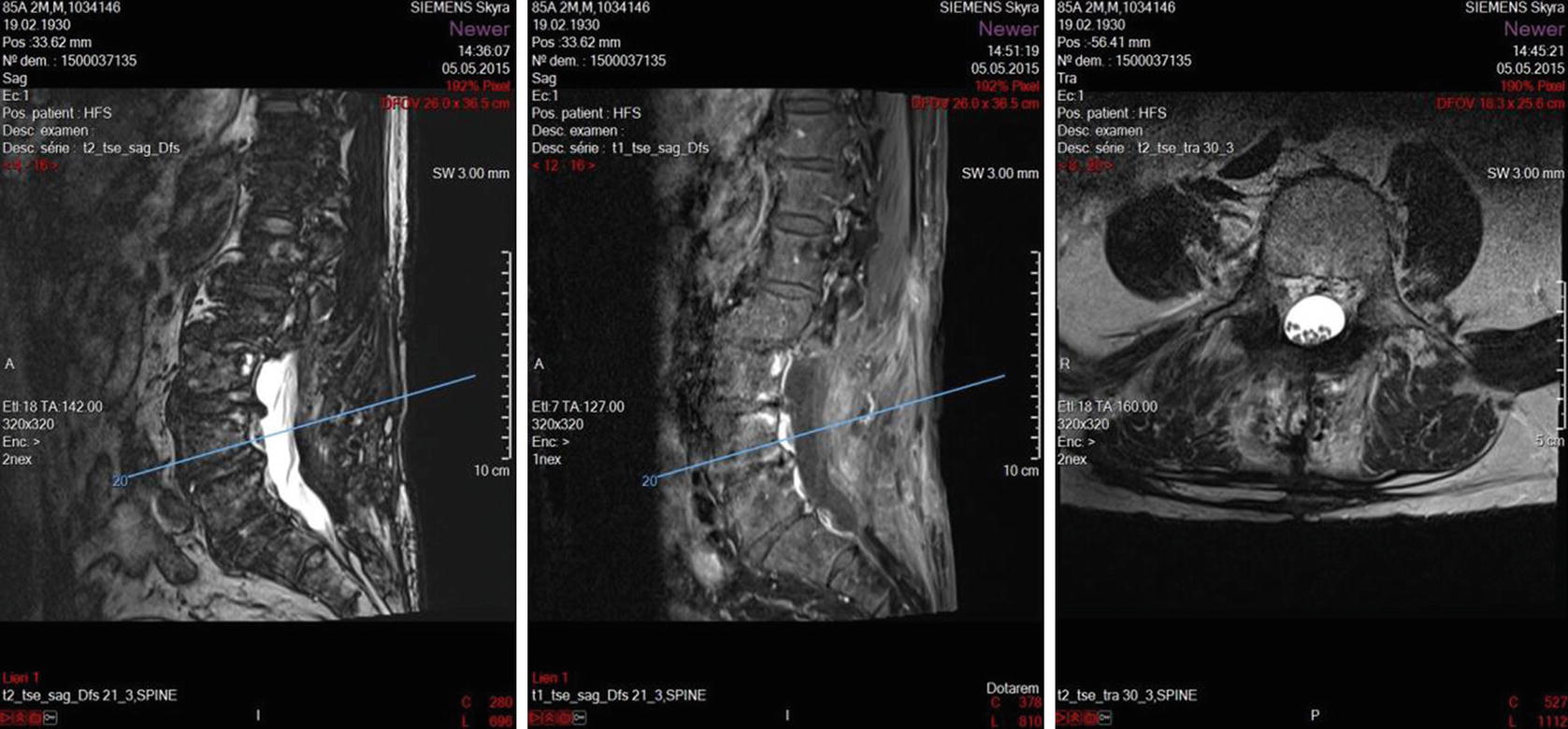 Management of CSF Fistula | SpringerLink