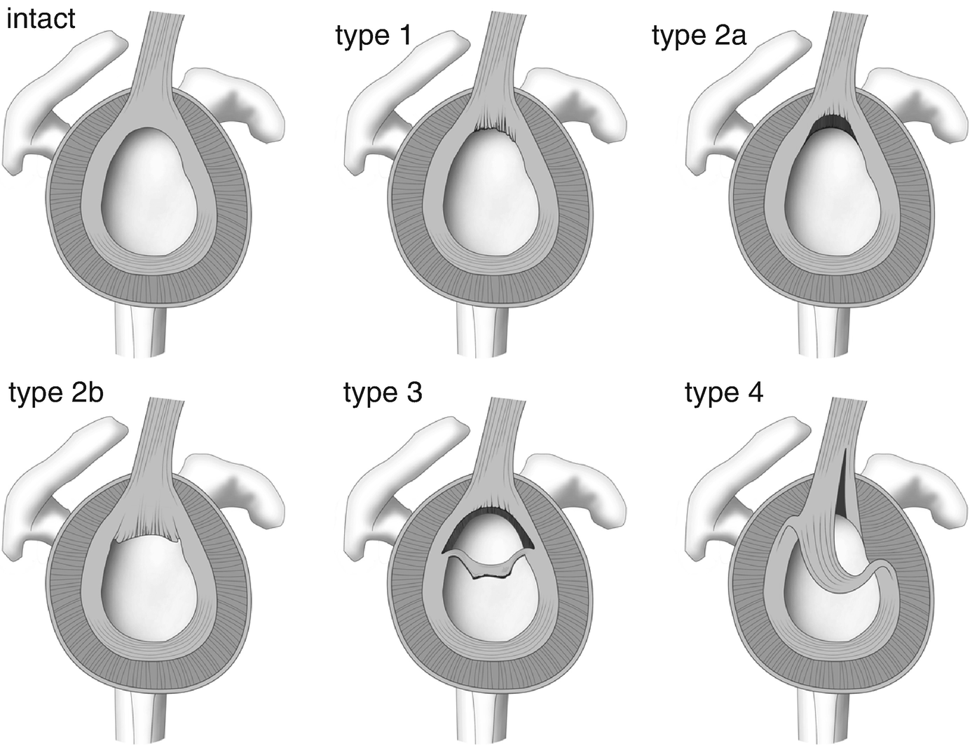 Anterior Glenohumeral Instability | SpringerLink