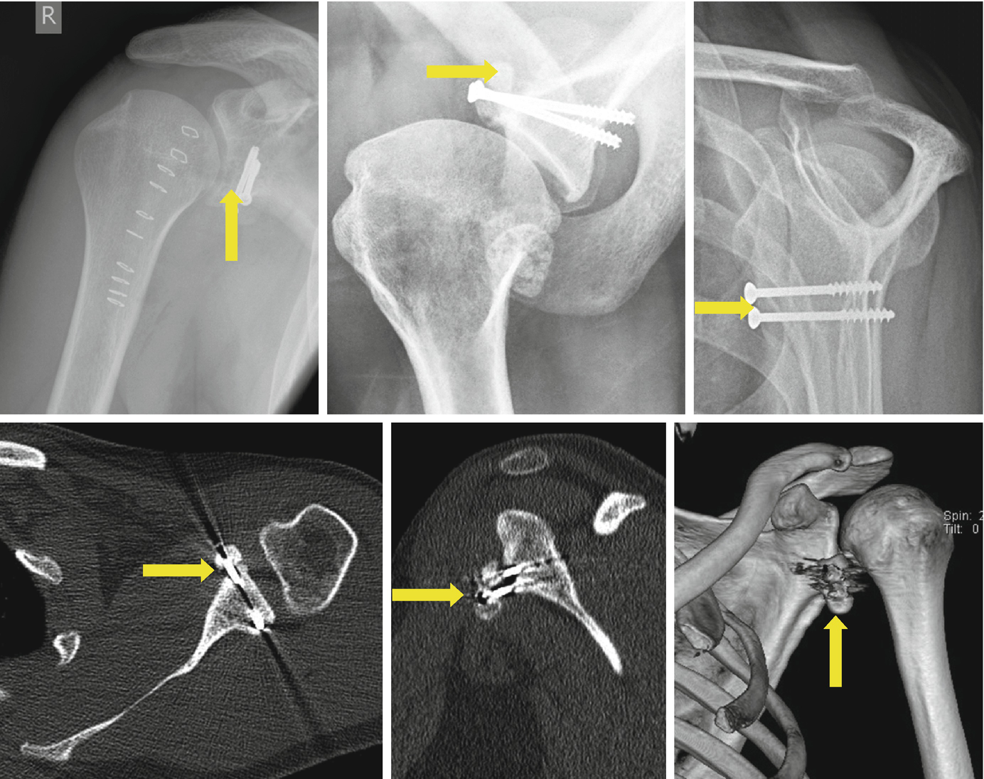 Anterior Glenohumeral Instability | SpringerLink