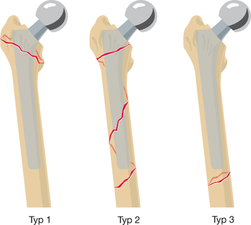 Hüftgelenk und Femur: Periprothetische Frakturen | SpringerLink