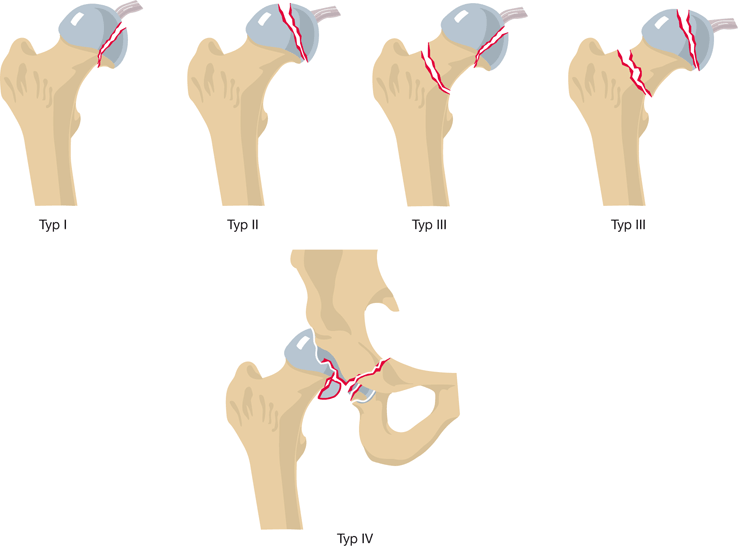 Hüftluxationen und Hüftkopffrakturen | SpringerLink