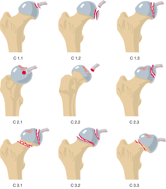 Hüftluxationen und Hüftkopffrakturen | SpringerLink