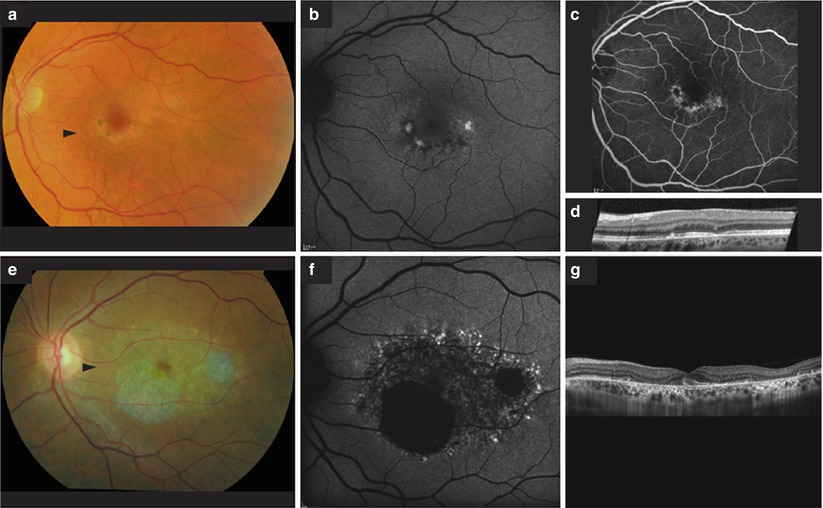 Fundus Autofluorescence Imaging in Retinal Dystrophies | SpringerLink