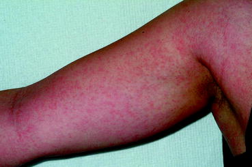 Cholinergic Urticaria and Exercise-Induced Anaphylaxis | SpringerLink