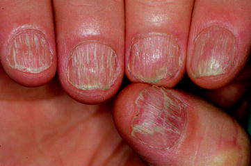 Nail Thinning | SpringerLink
