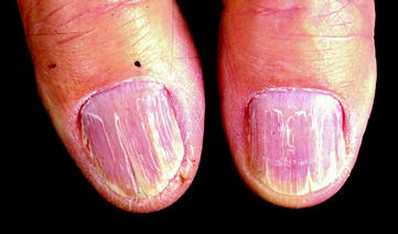 Nail Thinning | SpringerLink