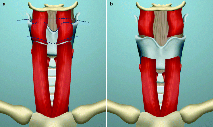 Subglottic and Tracheal Stenosis | SpringerLink