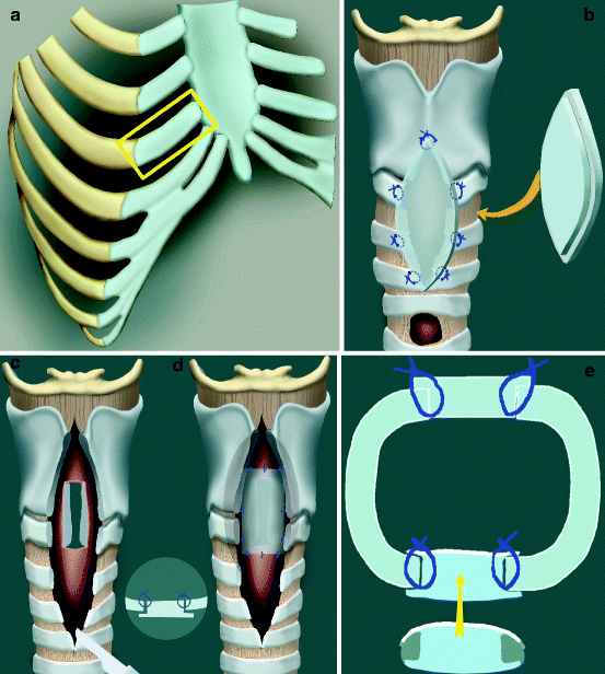 Subglottic and Tracheal Stenosis | SpringerLink