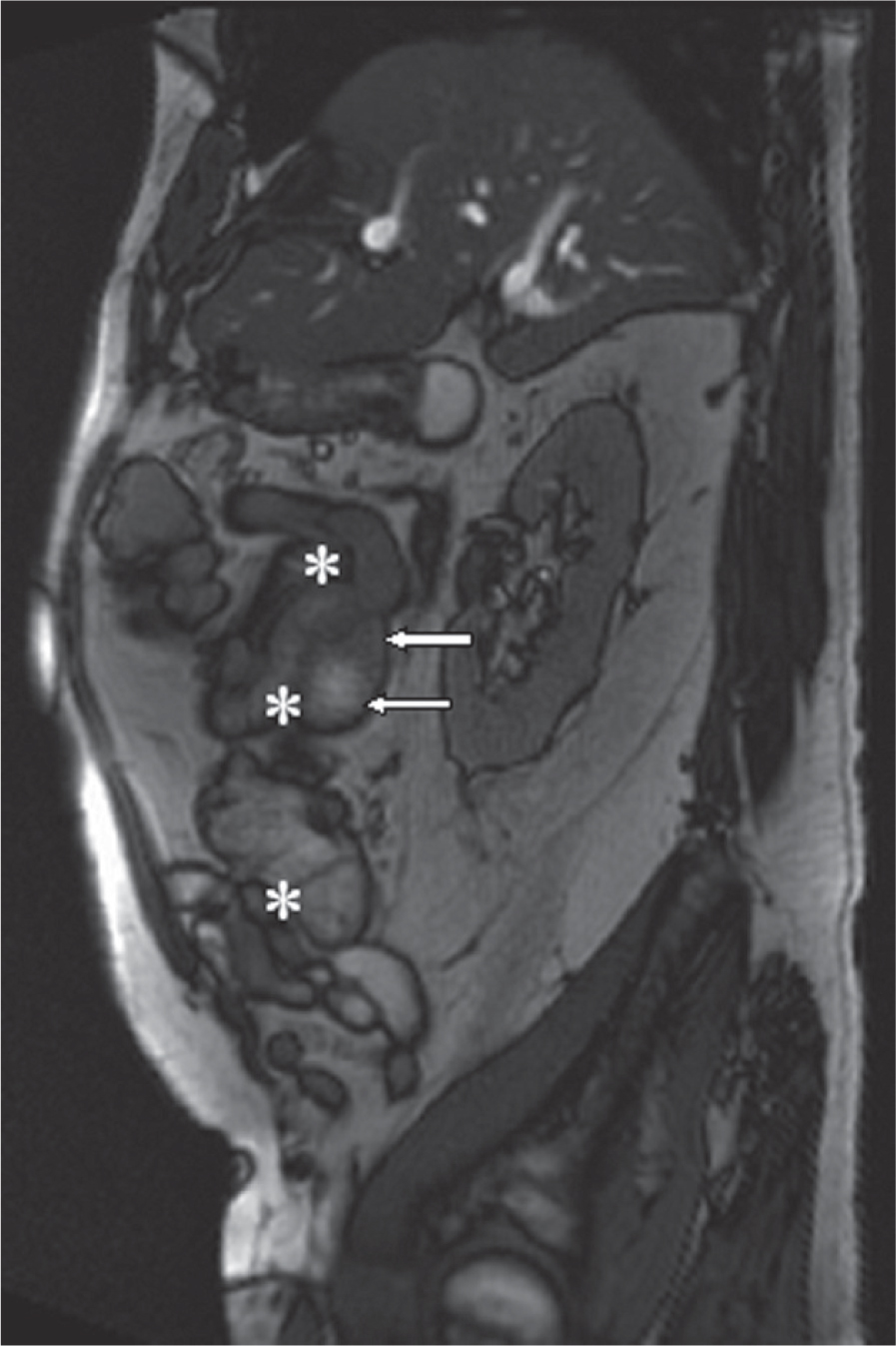 MRI of Adhesions and Small Bowel Obstruction | SpringerLink