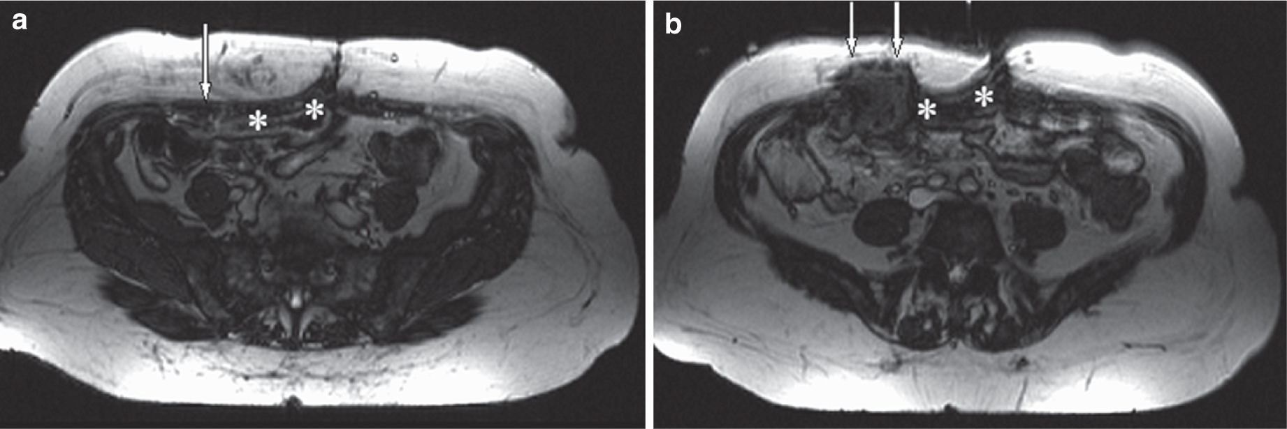 MRI of Adhesions and Small Bowel Obstruction | SpringerLink