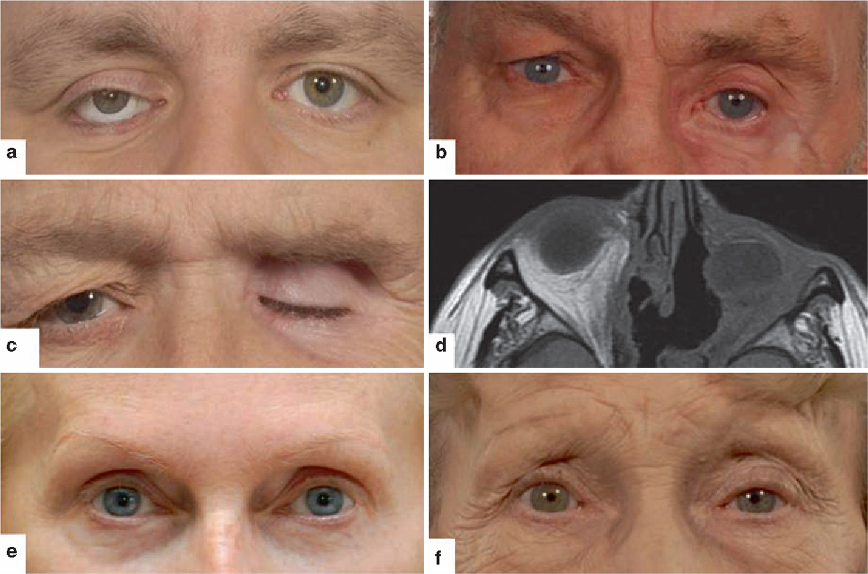 Non-surgical Volume Enhancement with Fillers in the Orbit and ...