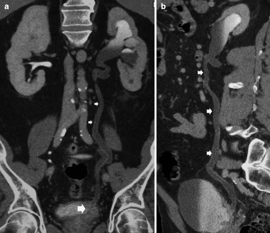 Obstructive Uropathy, Pyonephrosis, and Reflux Nephropathy in Adults ...