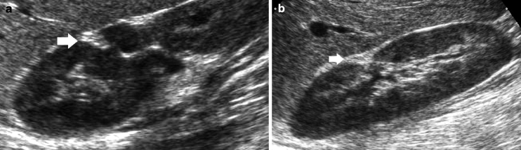 Normal Radiological Anatomy and Anatomical Variants of the Kidney ...