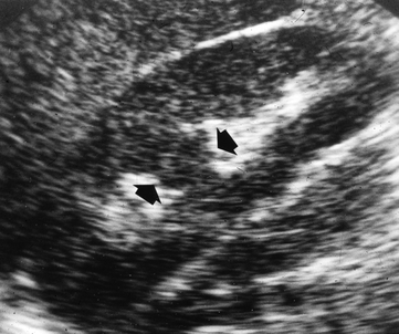 Normal Radiological Anatomy and Anatomical Variants of the Kidney ...