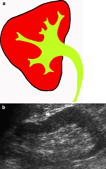 Normal Radiological Anatomy and Anatomical Variants of the Kidney ...